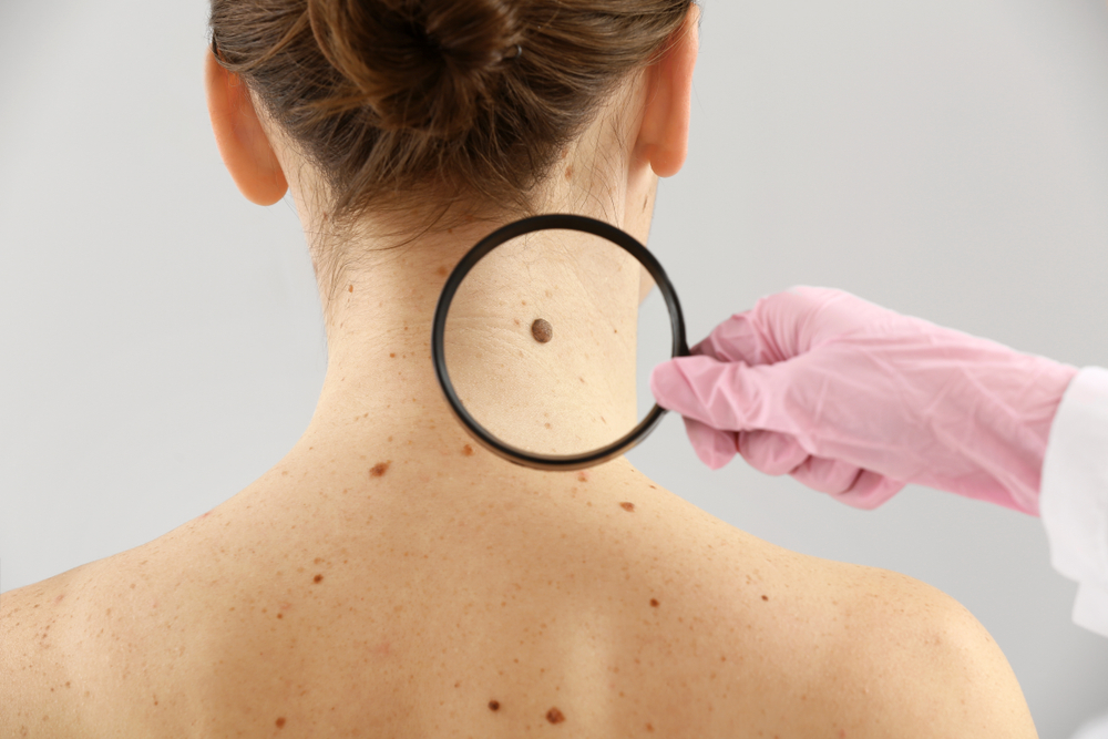 Skin Cancer Moles On Back
