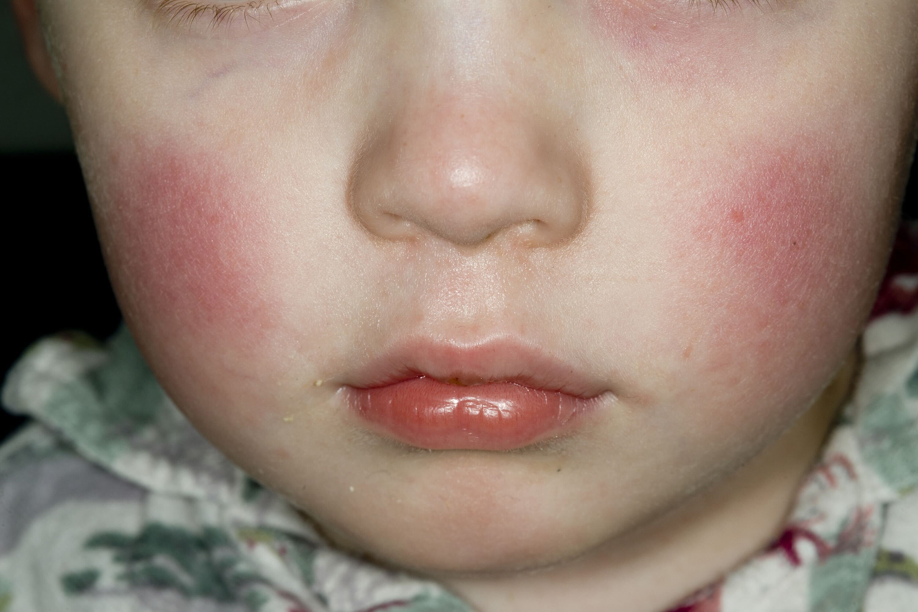 What to know about the 'slapped cheek' virus uptick in the U.S. | NPR & Houston Public Media