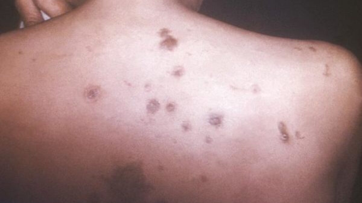 gonorrhea std rash
