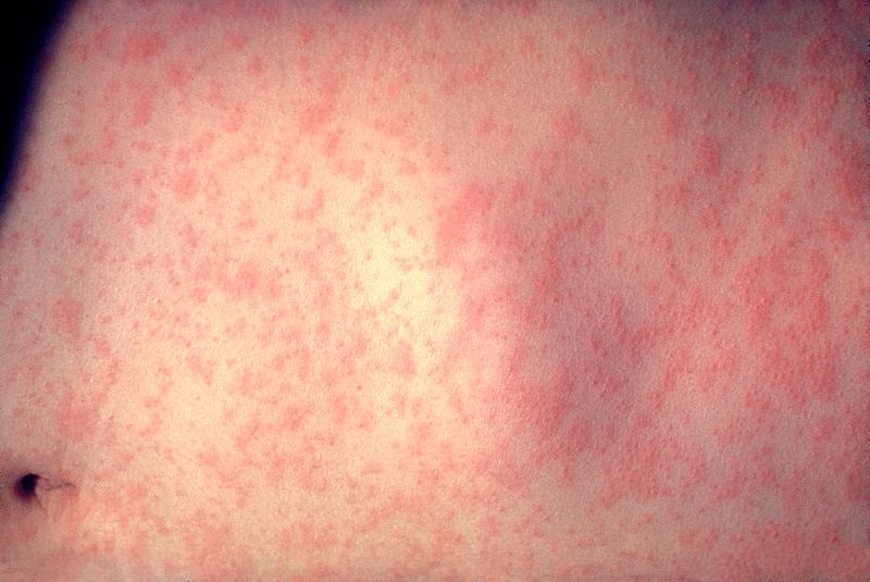 Salmonella Symptoms Rash